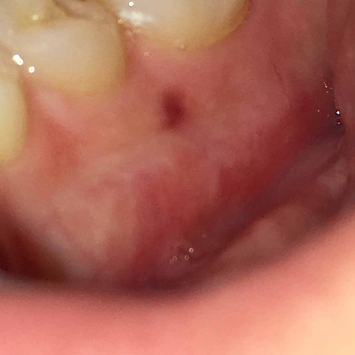 I have this purple dot on the inside of my gums, it's next to my molar ...