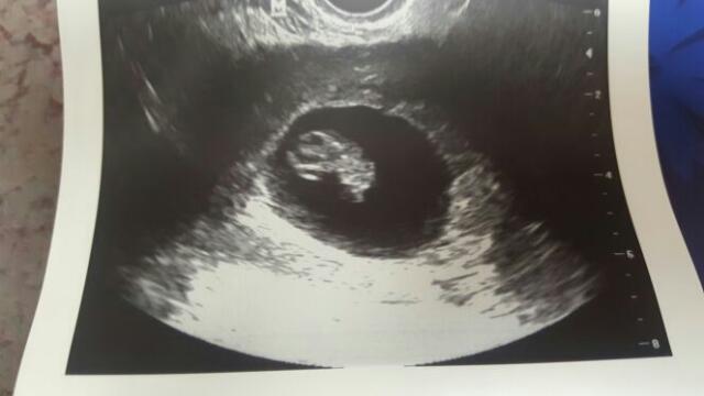 Missed Miscarriage At 8 Weeks