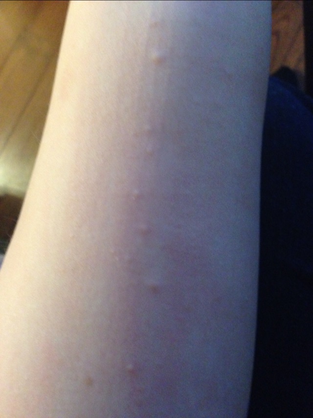 bumps after scratching - Glow Community