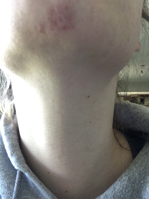 This random, hickey like, mark just appeared on my chin over the span ...