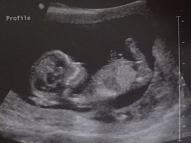 13 week scan boy or girl? - Glow Community