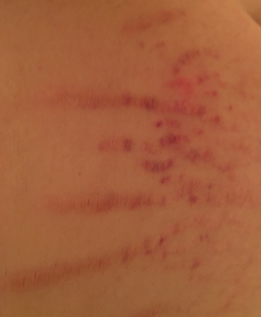 Bumps on stretch marks (don't judge me for my Mom Bod and stretch marks ...