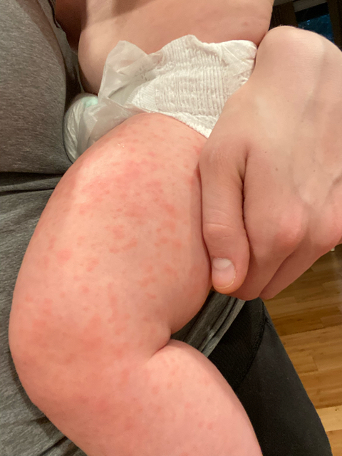 Amoxicillin Rash Baby