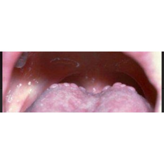 Hpv Warts On Back Of Tongue