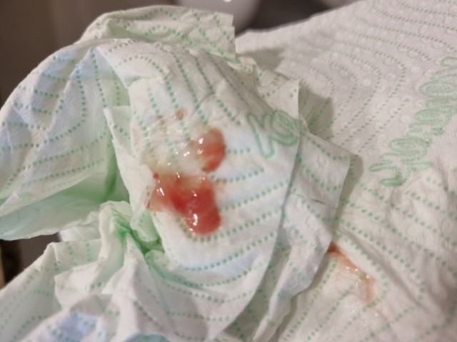 Cervix Exam 31 weeks + Mucus Plug...Should I be worried?!?!? - Glow ...
