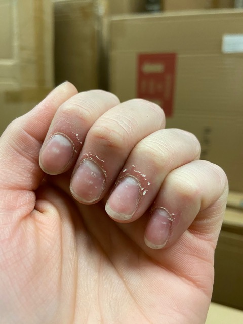 Peeling skin around cuticles - Glow Community