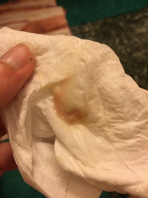 TMI mucus plug ? - Glow Community