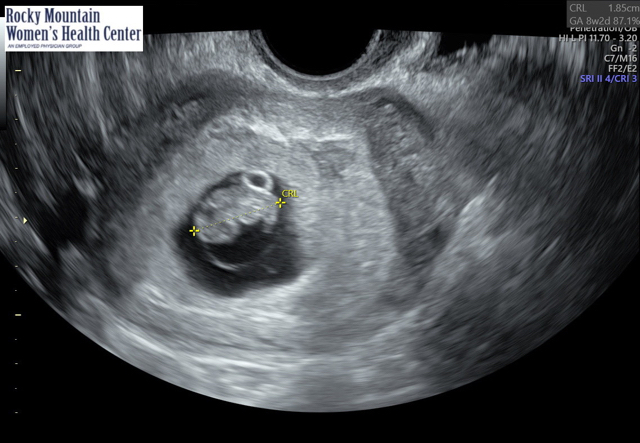 8weeks 2 days ultrasound - Glow Community