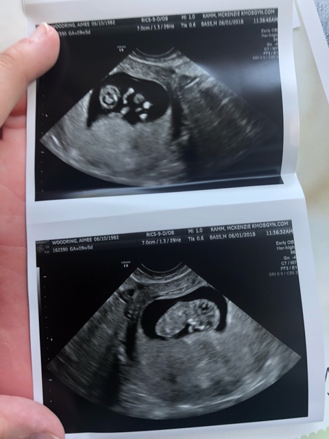 9 Weeks 4 Days Scan