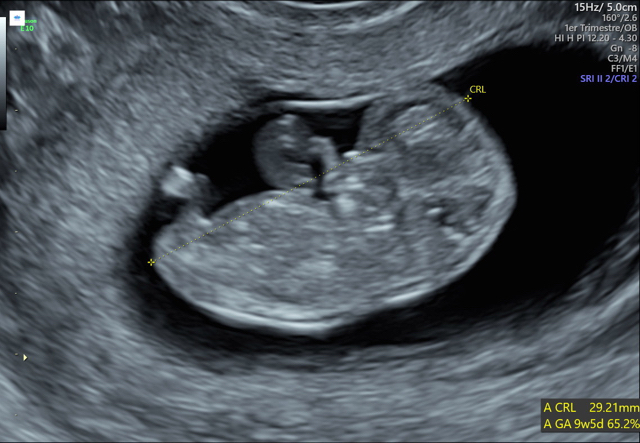 9w5d ultrasound for my triple rainbow! - Glow Community