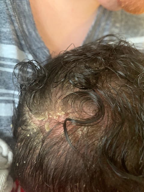 What is this on babies scalp?UPDATE - Glow Community