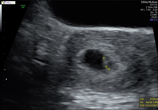 6w5d had first Ultrasound - Glow Community