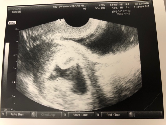 7 week scan 👶 - Glow Community