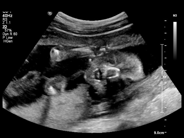 Cleft Lip 20 week scan??? - Glow Community