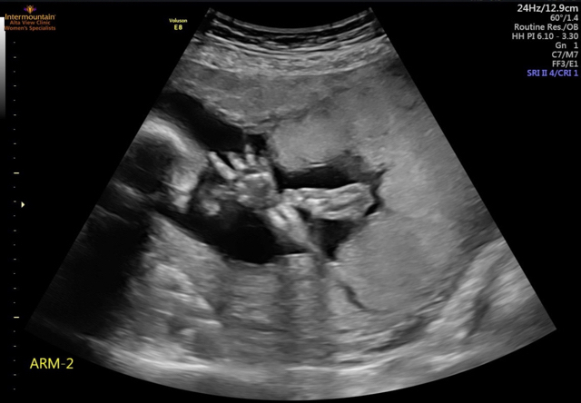 19w4d ultrasound of my sweet baby boy - Glow Community