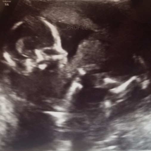 19 weeks Anatomy Scan! - Glow Community