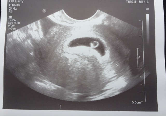 6 weeks, 5 days! First ultrasound! - Glow Community