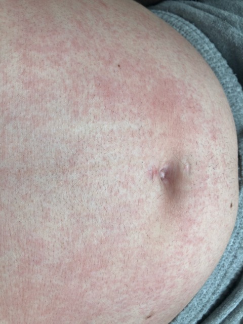 Red rash all over my pregnant belly. - Glow Community
