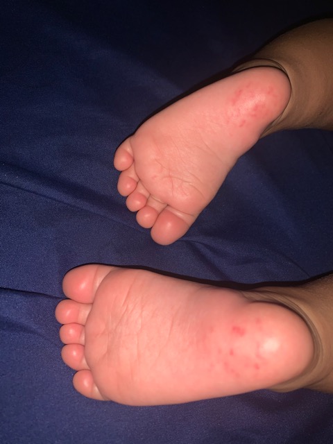 Red spots on baby’s feet? - Glow Community