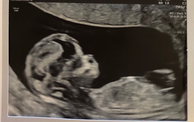 13 weeks 1 day! Nub theory? Anyone got an idea?💗💙 - Glow Community