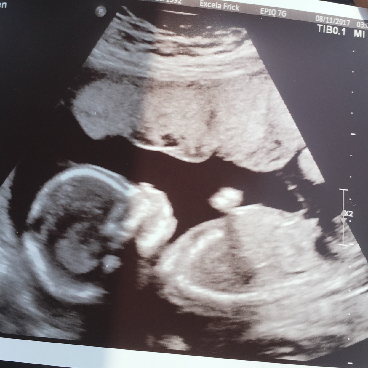 Anatomy Ultrasound At 18 Weeks