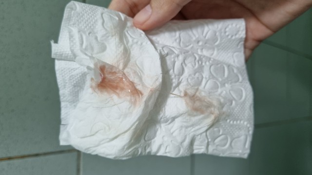 Implantation Bleeding Brown Stringy Discharge