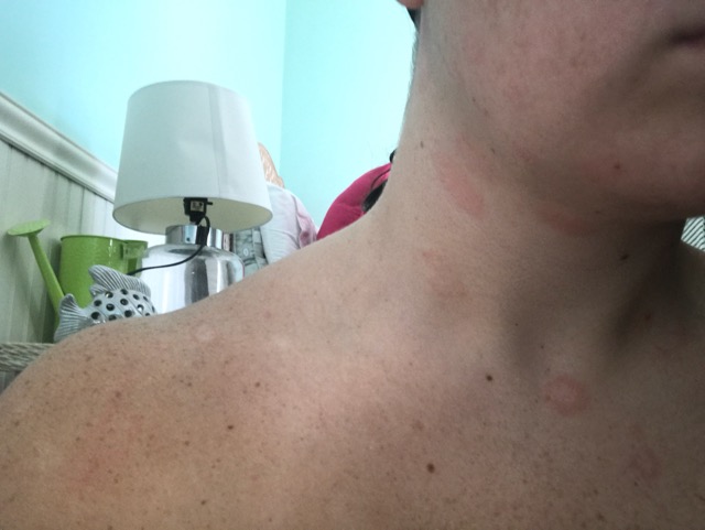 does anyone know what this rash is? ive had it for a month it started ...