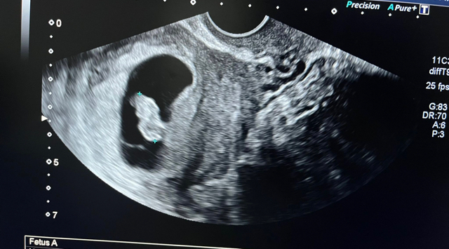 What Does Placenta Look Like On 8 Week Ultrasound